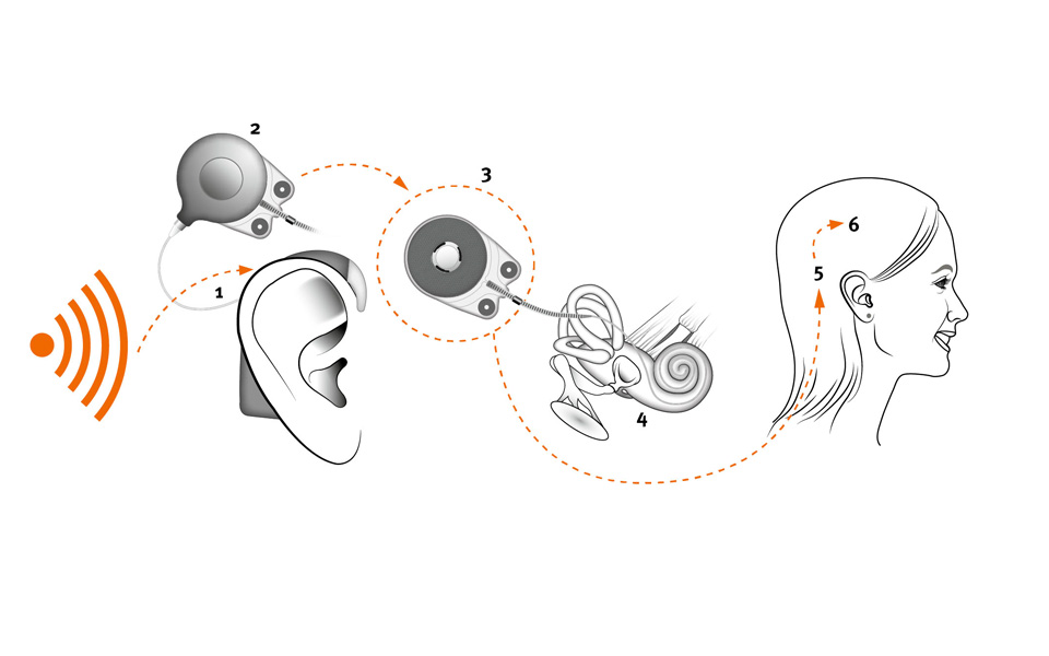 Cochlear Implant Users | Oticon Medical